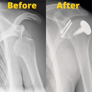 Bankart Repair